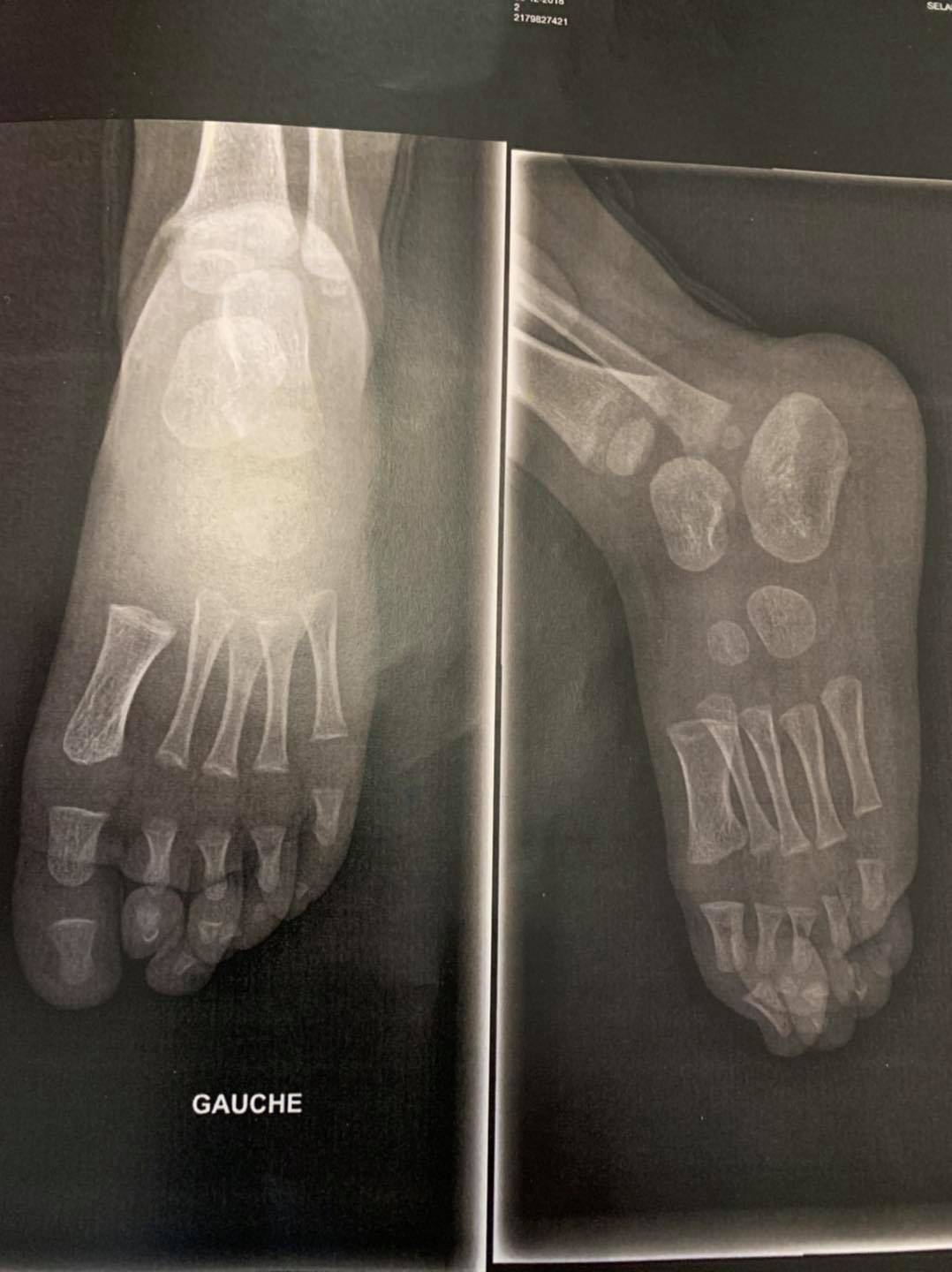Radiographie Des Os Du Pied
